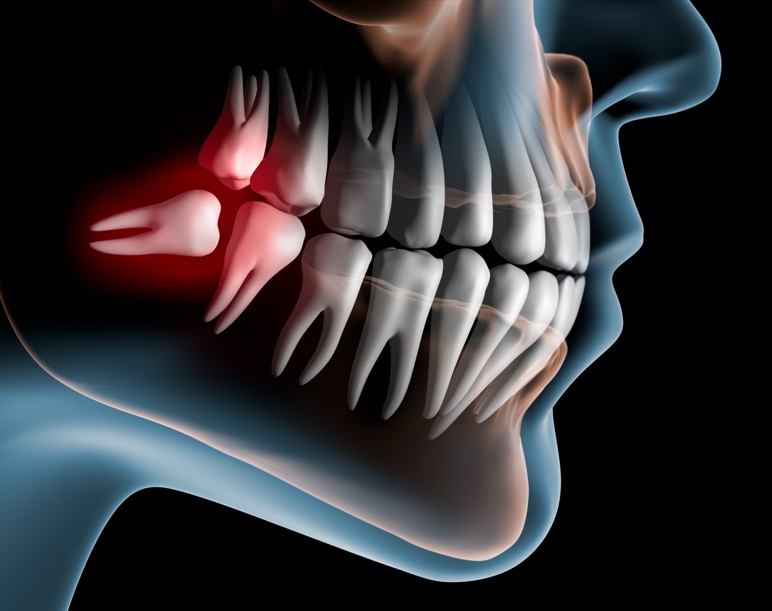 Lying Wisdom Tooth in the Lower Jaw – 3D Rendering | Bamonte Oral Surgery